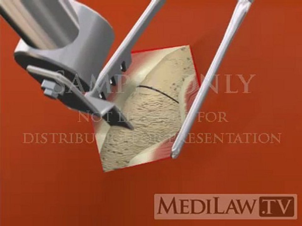 Bone Graft Harvesting Surgery anterior iliac crest orthopedic ...