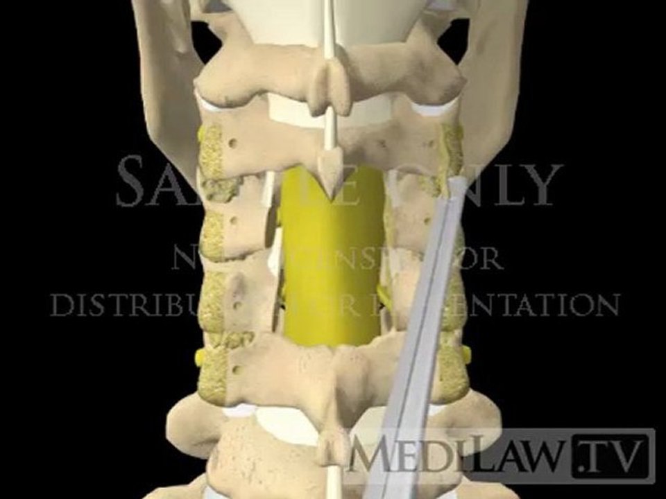 Cervical Spine Surgery Decompression Laminectomy + Lateral Mass Screw ...
