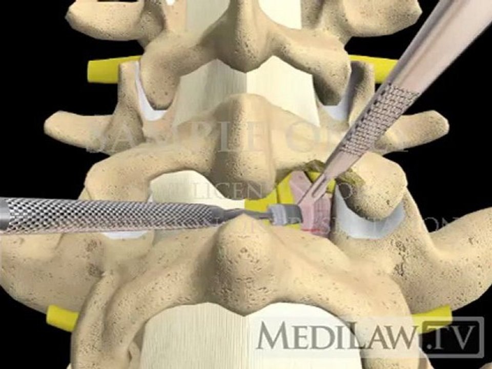 Lumbar Spine Surgery Posterior Micro-discectomy Discectomy neurosurgeon ...