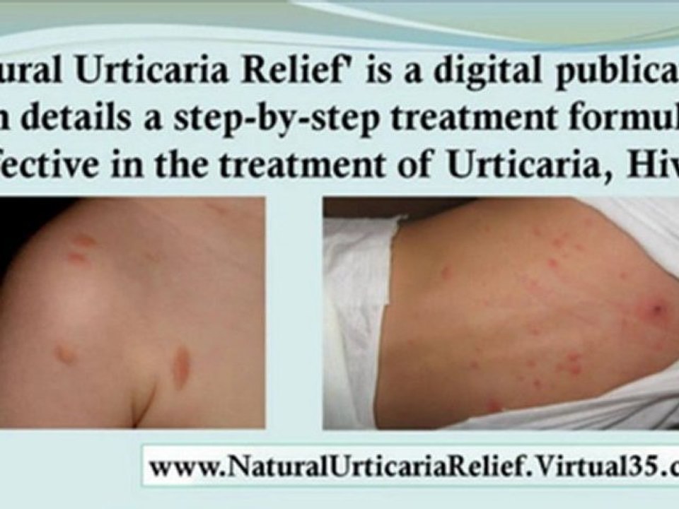 papular urticaria treatment - pruritic urticarial papules - delayed ...