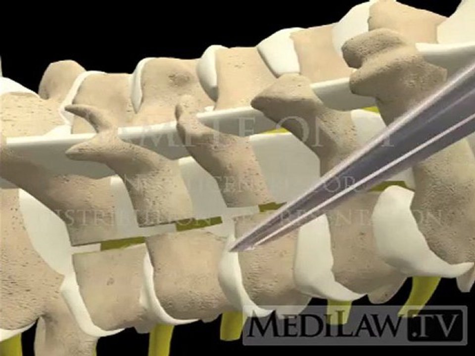 Cervical Spine Laminectomy neuro-surgery 3D animations - video Dailymotion