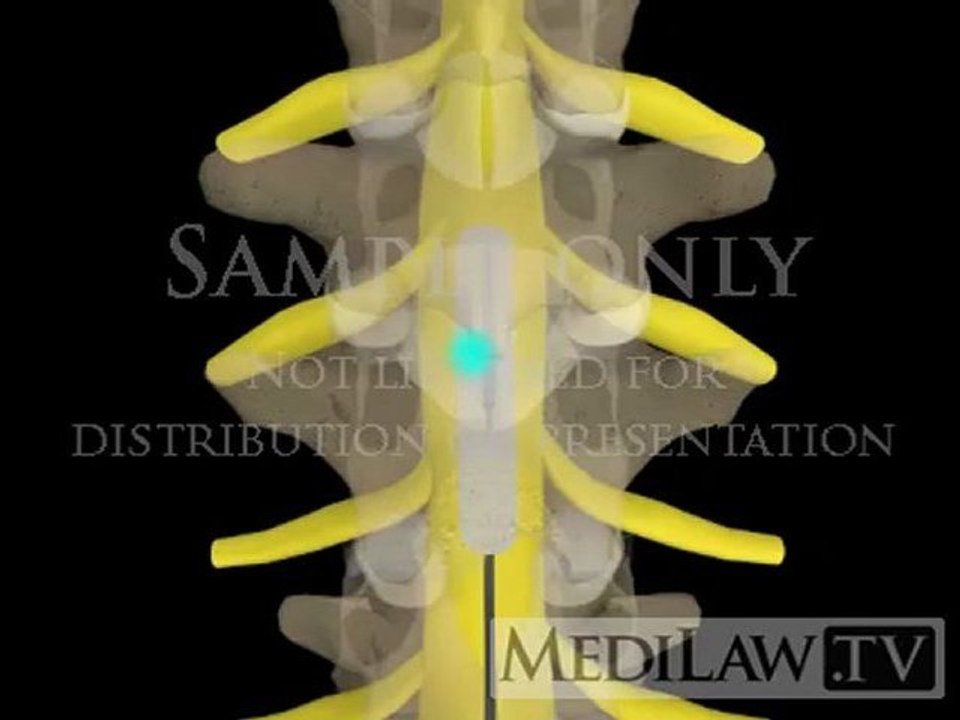 Lumbar Spinal Cord Neuro-stimulation paddle electrode pain management ...