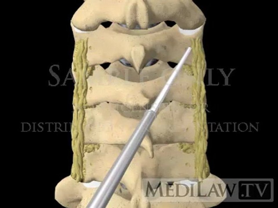 Cervical Spine Lateral Mass Screw Fusion Fixation neuro-surgical videos ...