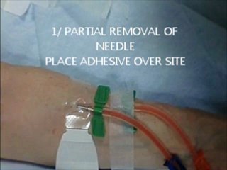 nephrokit videos - Dailymotion