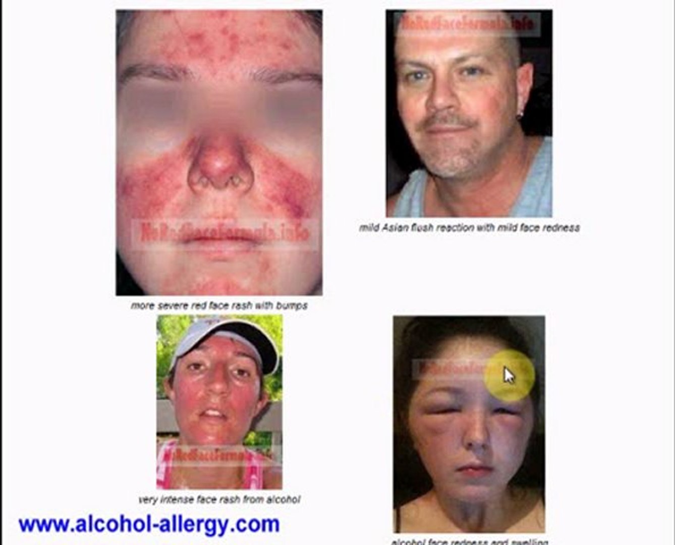 Alcohol Poisoning Rash On Face