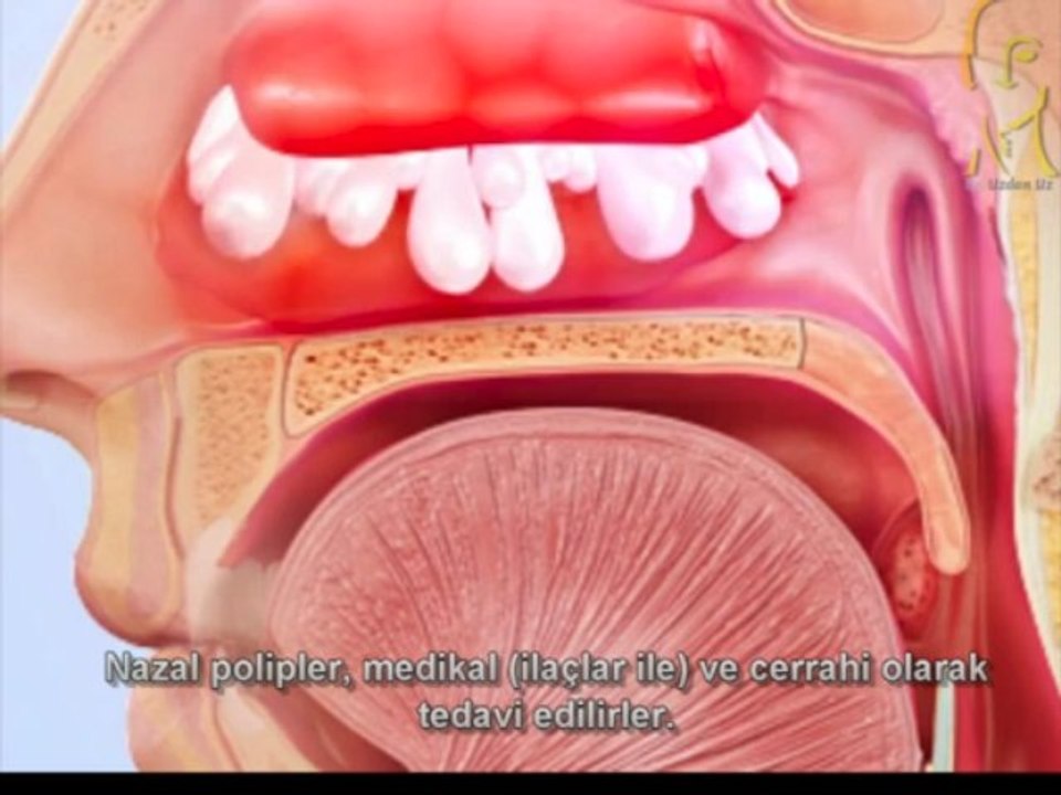Nazal Polip (Burun Polibi) ve Nazal Polip Tedavisi (Endoskopik Sinüs ...