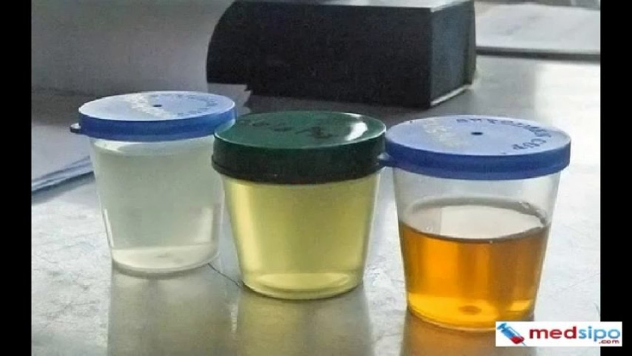 GGT Test (Gamma Glutamyl Transferase Test - Normal Range, Sample ...