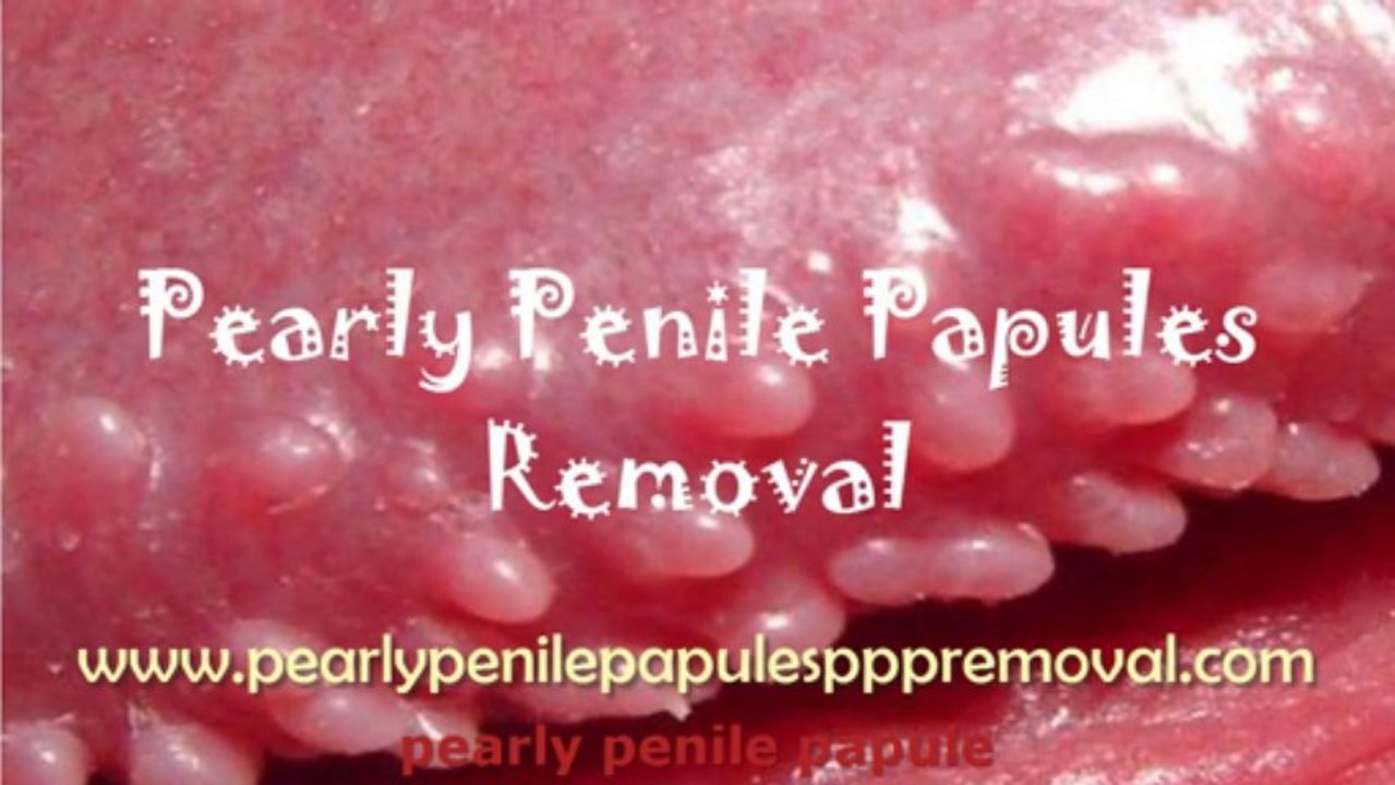 pearly papules removal from home without any surgical treatment low ...