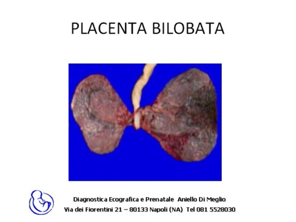 Placenta bilobata - Video Dailymotion