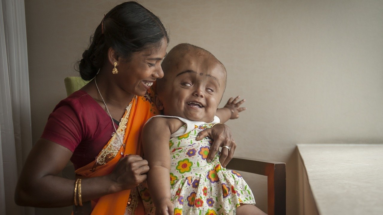 Swollen Head Baby: Roona Begum's Incredible Journey - video Dailymotion