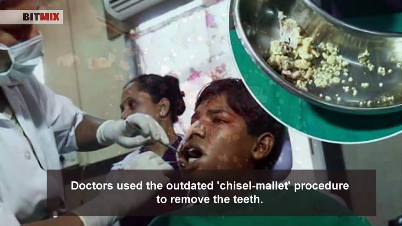 232 Teeth Removed from 'World Record' Surgery | Ashik Gavai - video ...
