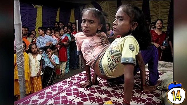 People With Extra Body Parts