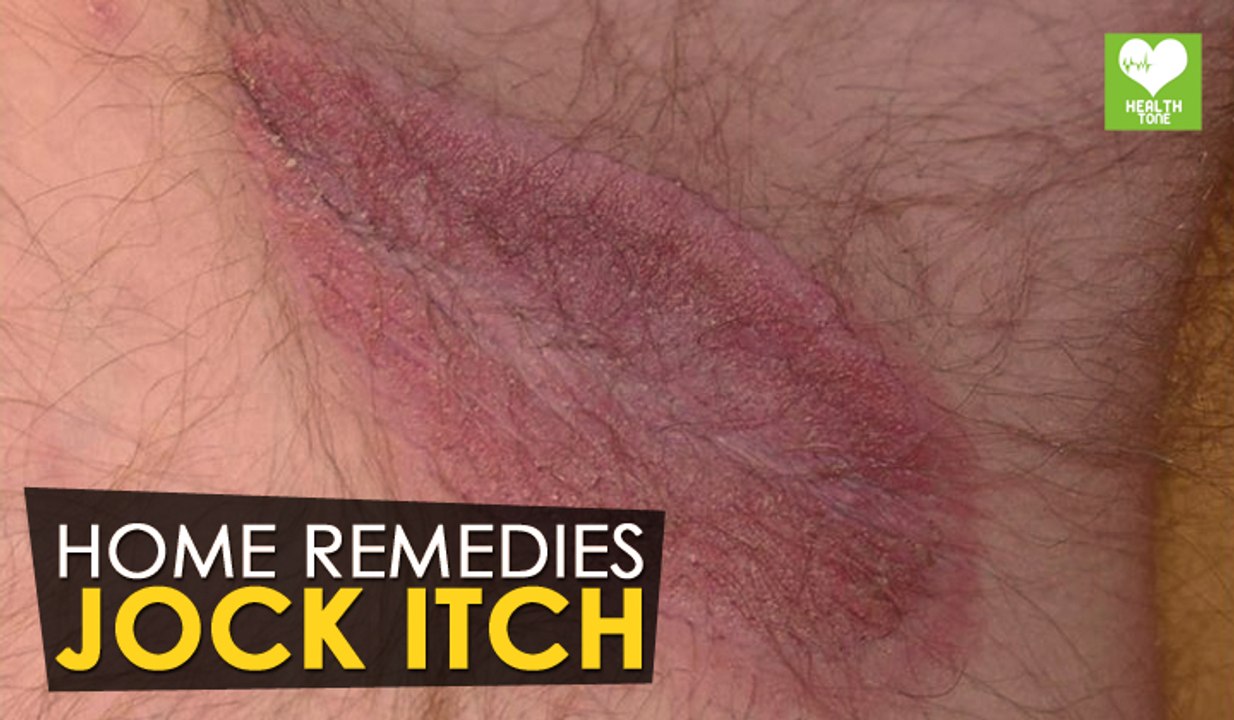 Jock Itch Treatment Home Remedies Health Tone Tips Video Dailymotion