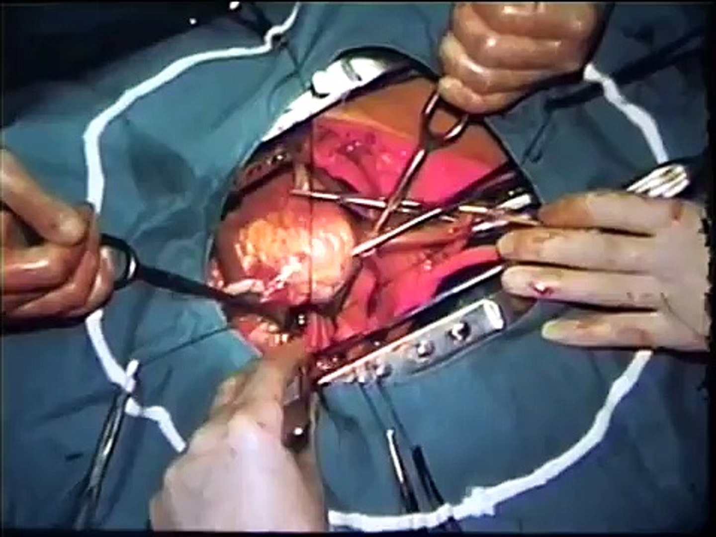 Open Heart Surgery Video