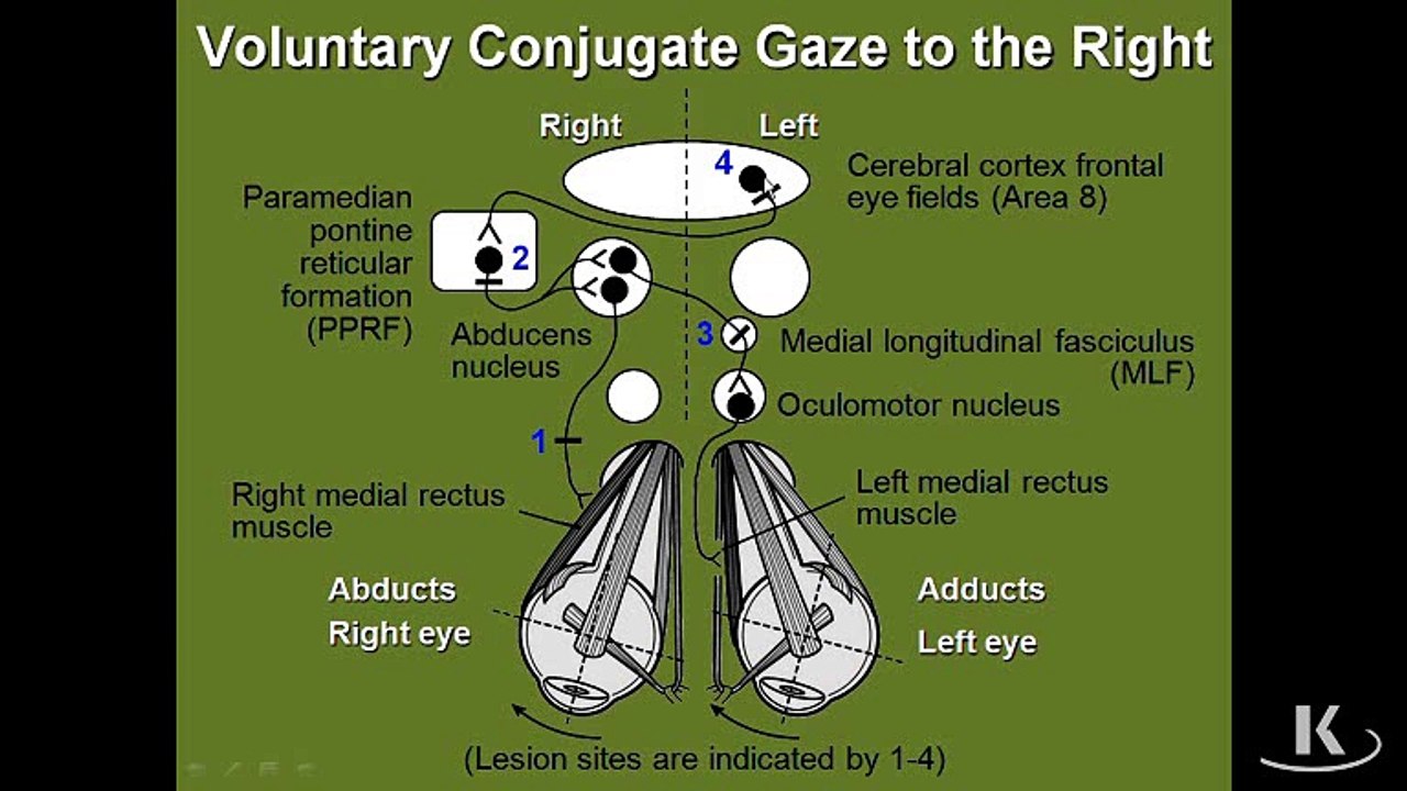 Conjugate gaze palsy - video Dailymotion