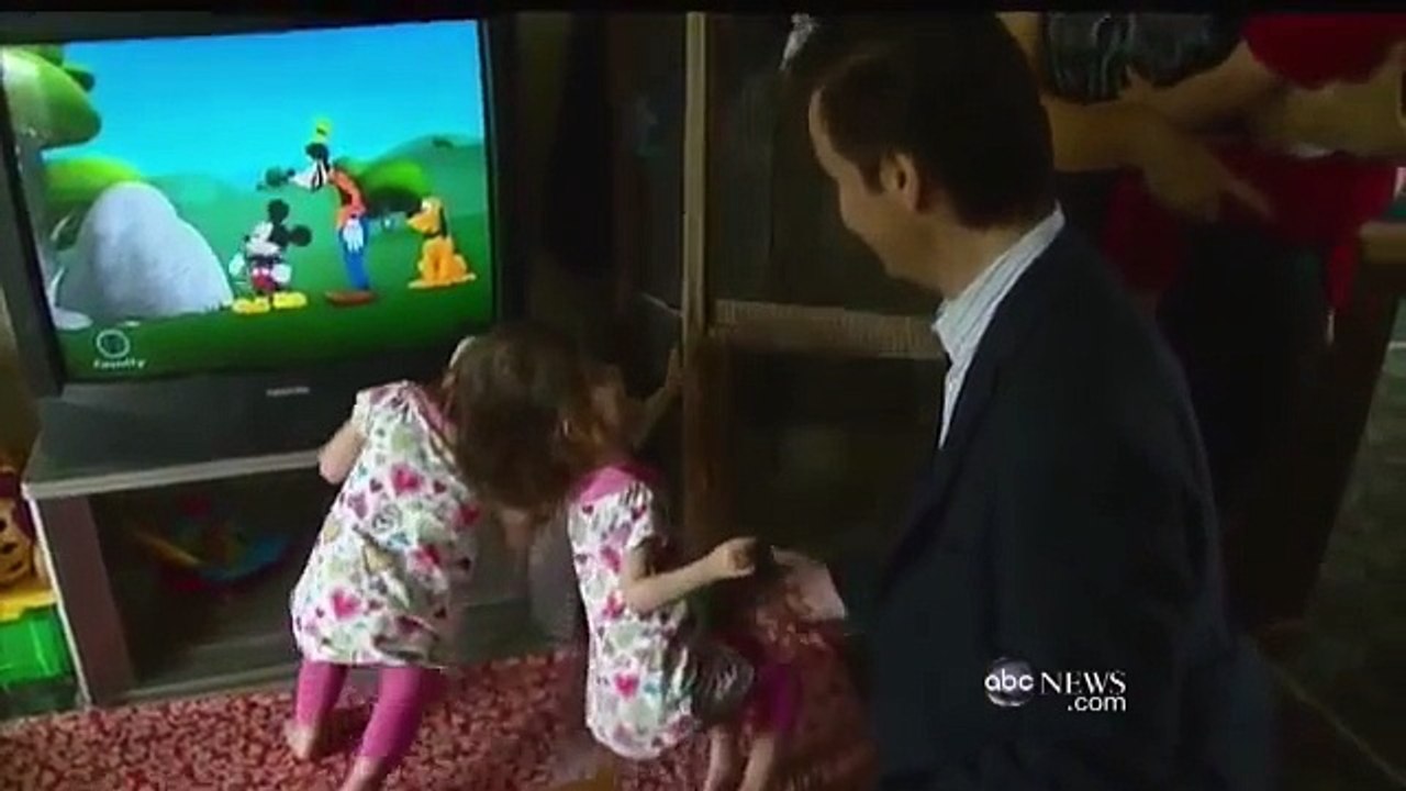 Conjoined Twin Girls Craniopagus sharing their brain - video Dailymotion