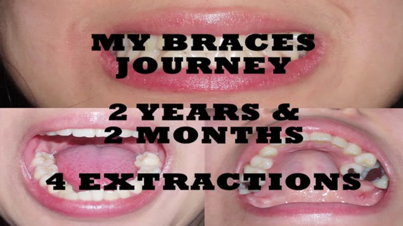 Adult Braces Journey Before and After Time Lapse Photos - Dailymotion Video