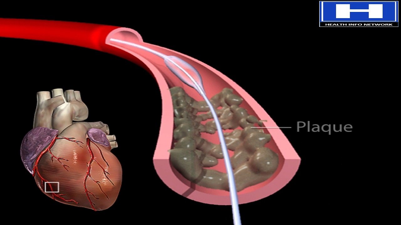 How Balloon Angioplasty is Done Animation - Coronary Angiography ...