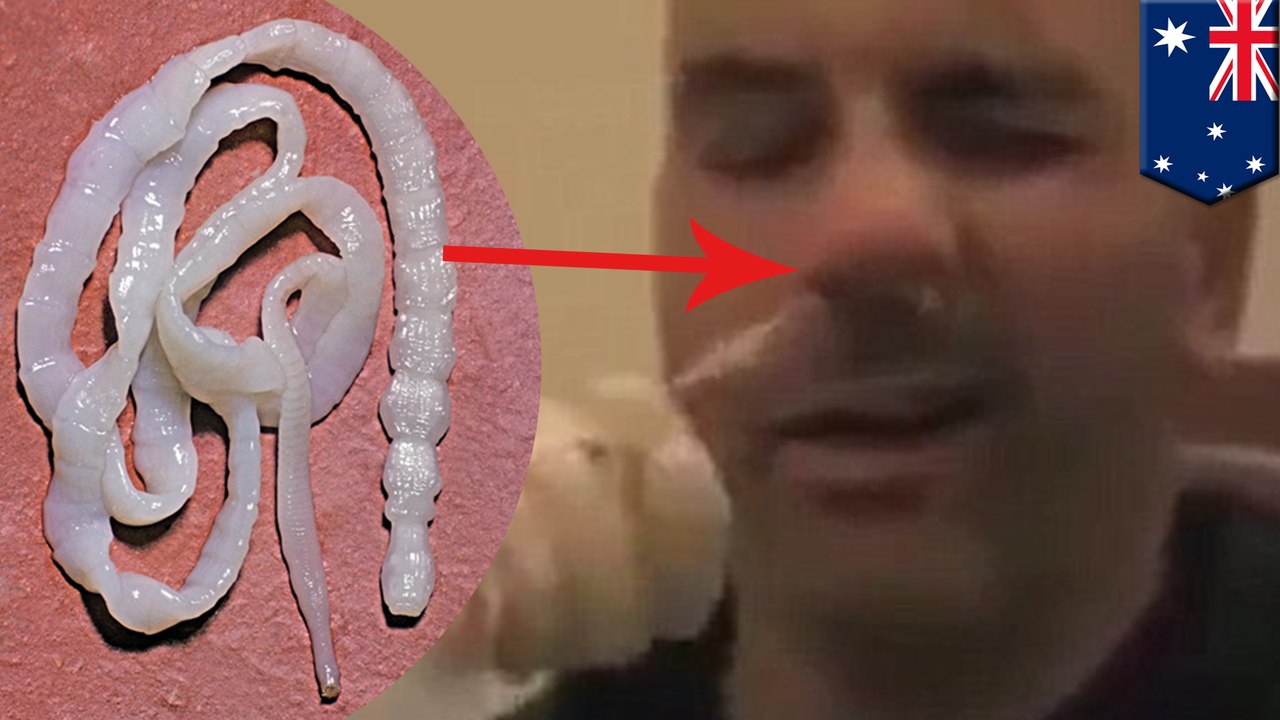 Man gets 5-foot-long tapeworm extracted from nose in horrifying video ...