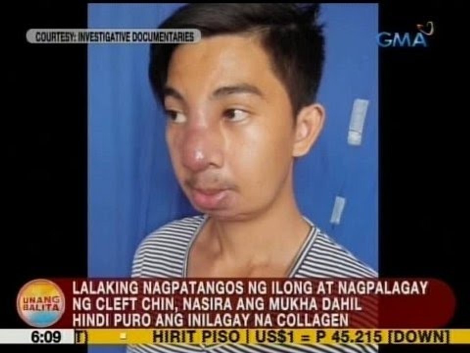 UB: Lalaking nagpatangos ng ilong at nagpalagay ng cleft chin, nasira ...