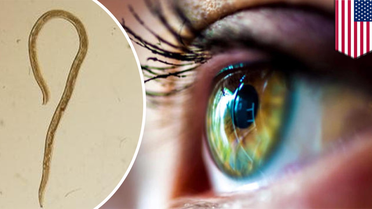 14 worms pulled from Oregon woman's eye - video Dailymotion
