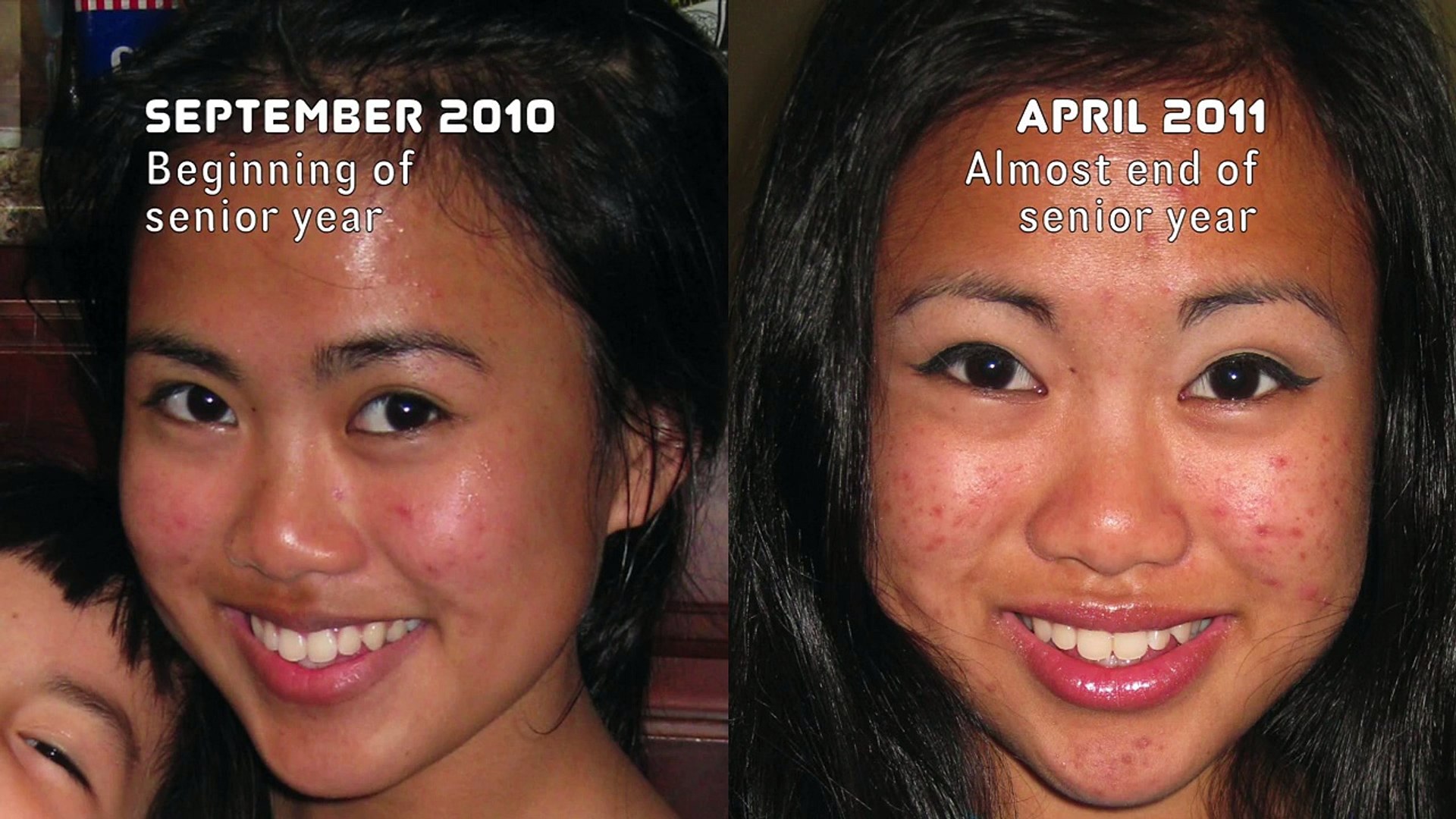 Accutane Results Timeline