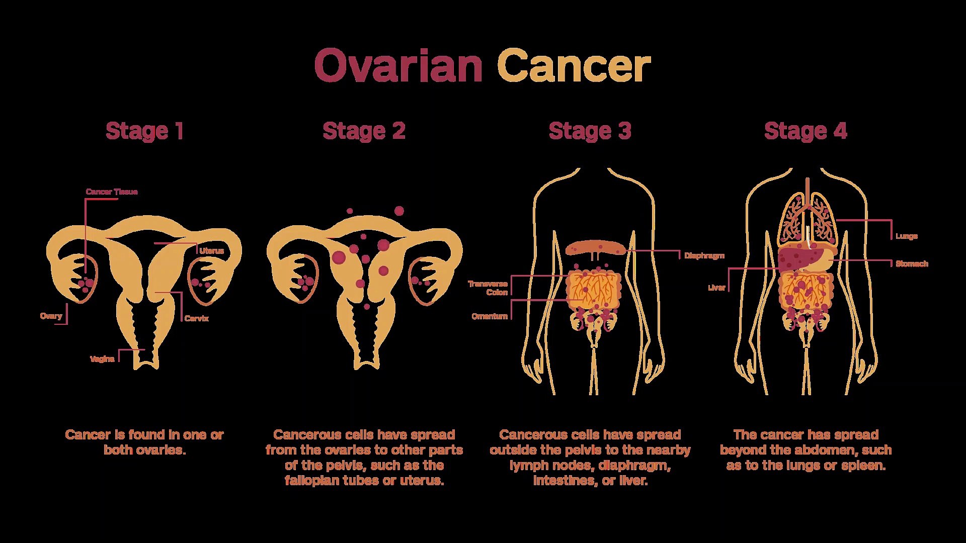 Ovarian Cancer Staging
