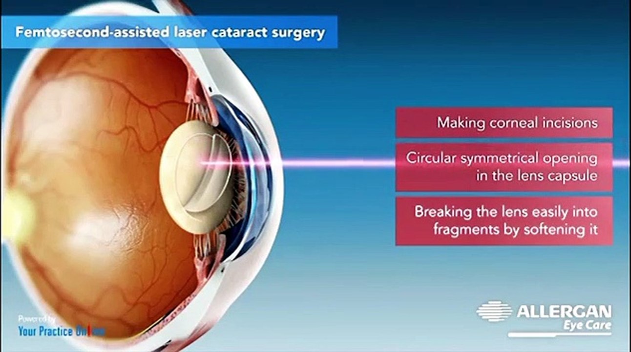 Information about Cataract surgery | Different Methods | Phaco ...