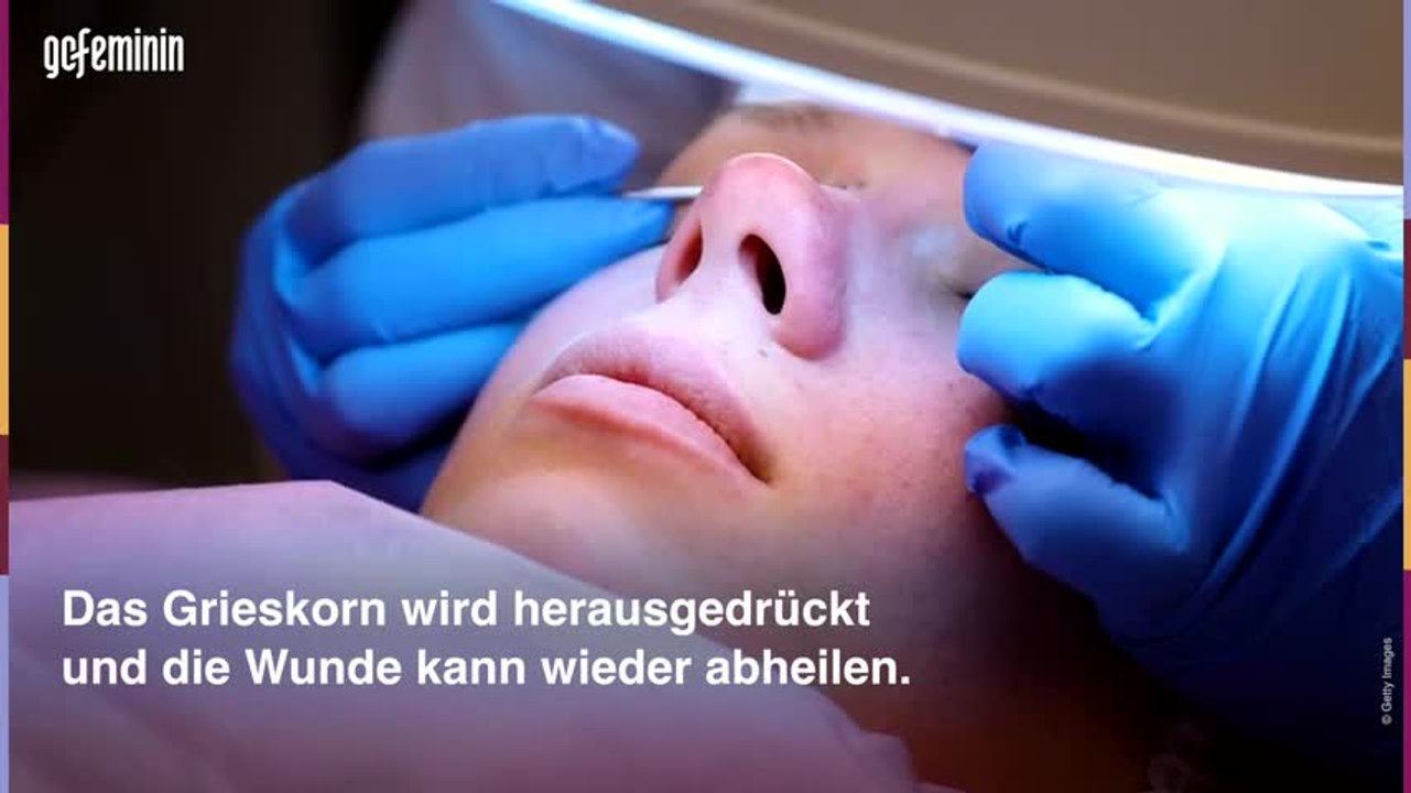 Milien entfernen: So werdet ihr die Grieskörner los - video Dailymotion