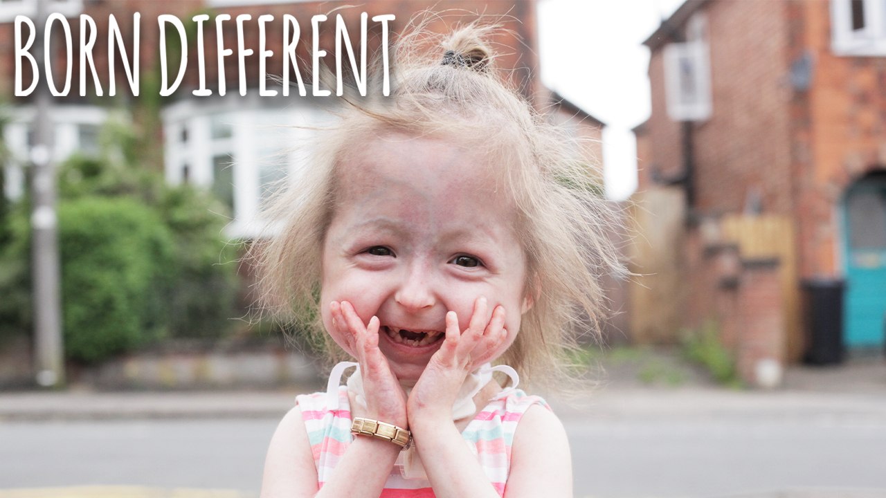 The Only Girl In The World With 'Benjamin Button' Disease | BORN ...