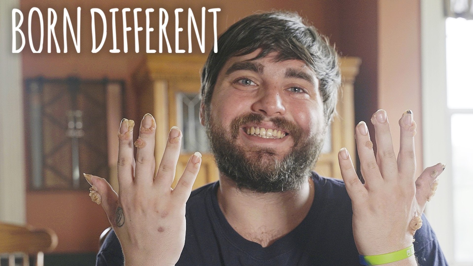 Epidermodysplasia Verruciformis Histologi Epidermodysplasia