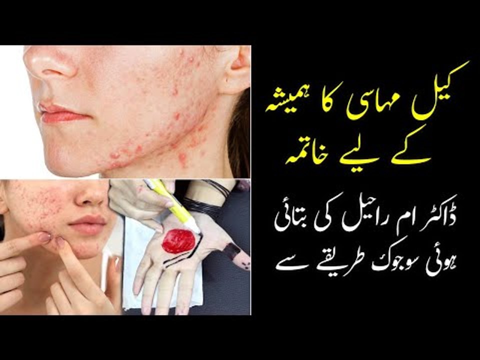 Keel Muhase Ka Gharelu Ilaj | Acne Treatment At Home | Sujok Therapy ...