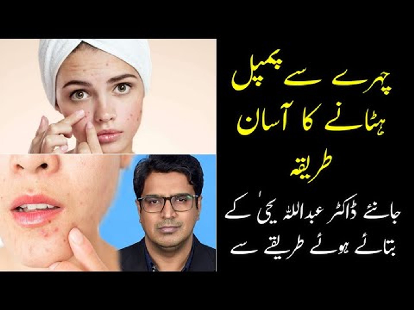 Blackheads On Face Tips In Urdu