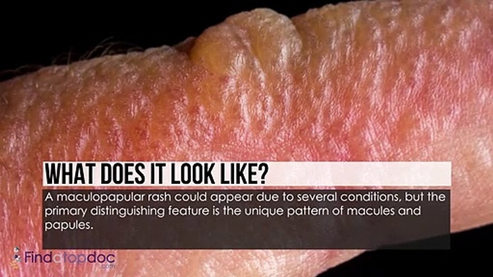 Maculopapular Rash