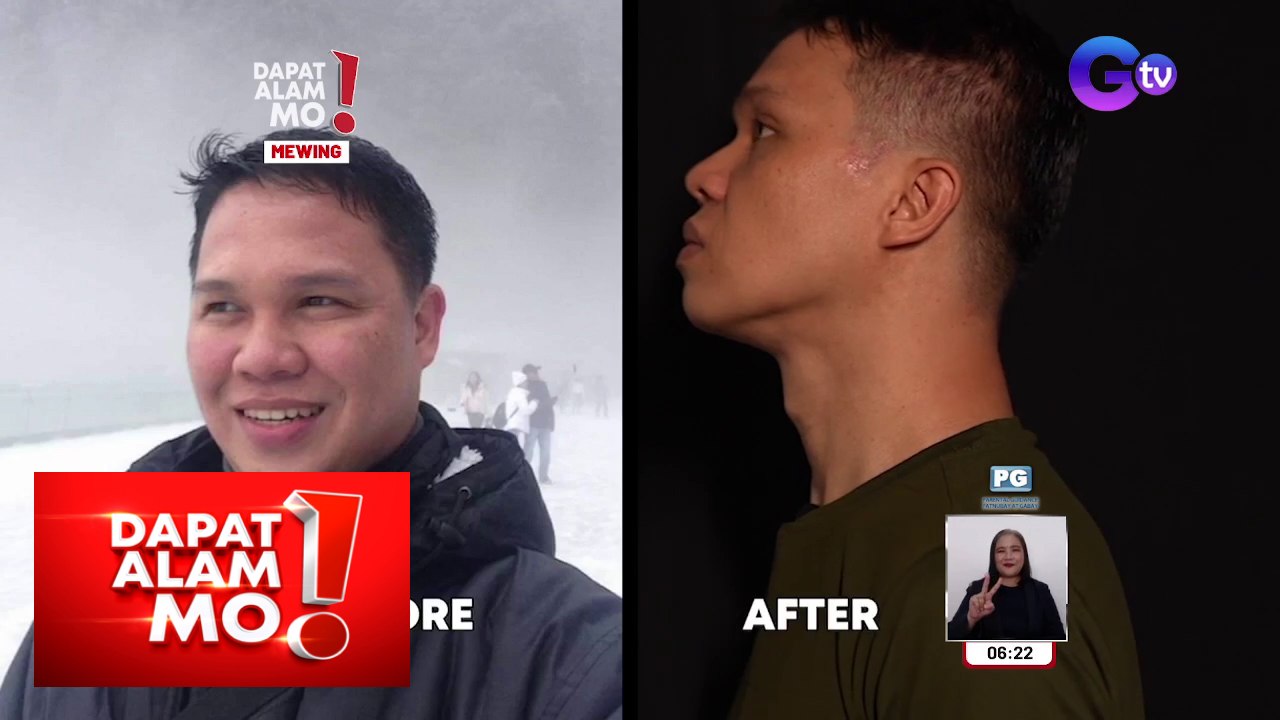 ‘Mewing’, sagot sa pangong ilong at double chin? | Dapat Alam Mo ...