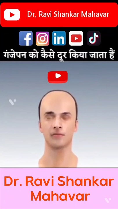 गंजापन दूर करने की सर्जरी। #shorts @Dr. Ravi Shankar Mahavar - video ...