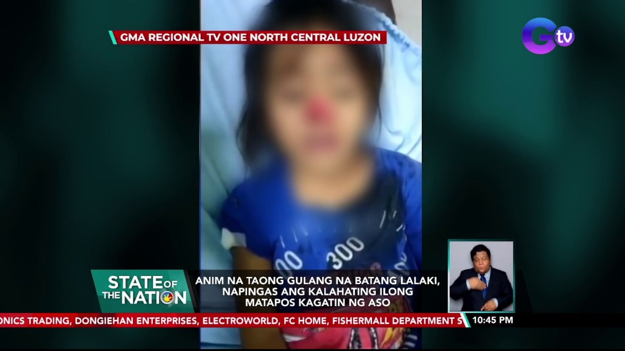 Anim na taong gulang na batang lalaki, napingas ang kalahating ilong ...