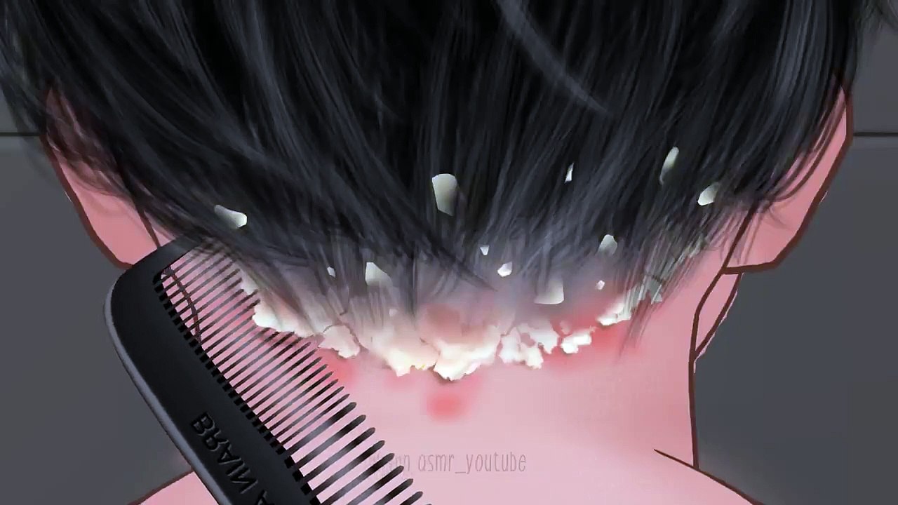 ASMR Removal Big Flakes Dandruff Scalp Satisfying - 보기만해도 시원한 대왕 두피각질 ...