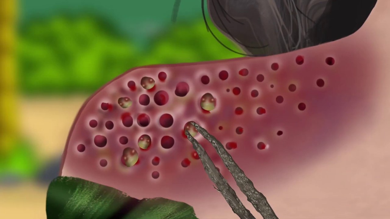 ASMR Remove Big Acne, Maggot Infection & Dry Mouth, Lip Care Animation ...