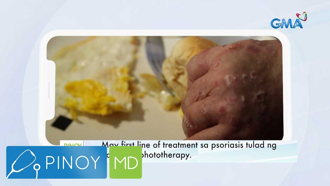 Ano nga ba ang lunas sa psoriasis? | Pinoy MD - video Dailymotion