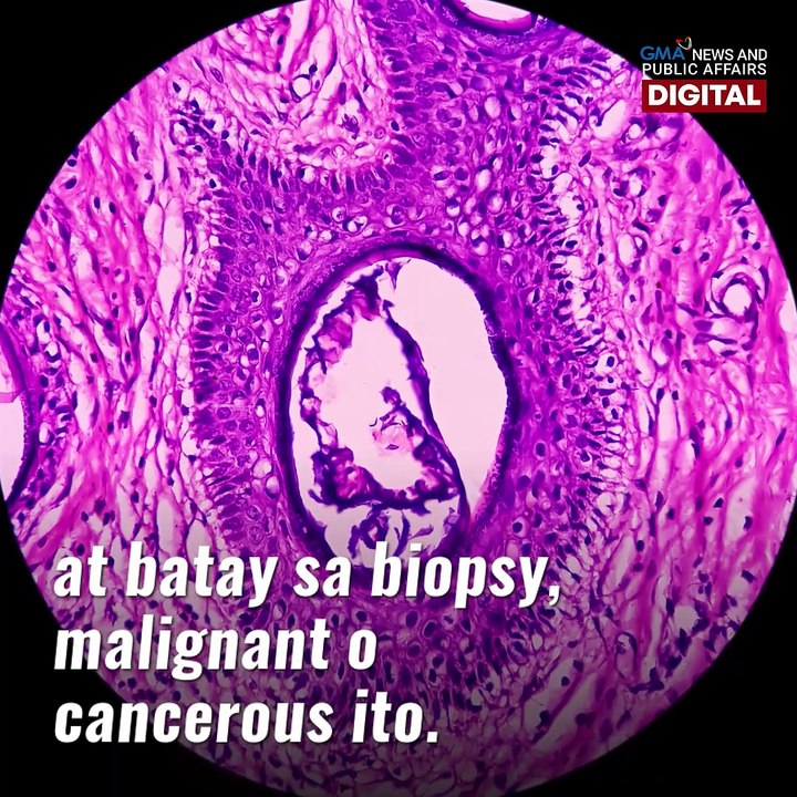 Babaeng laging sumasakit ang tiyan, may mahigit 100 tumor na pala sa ...