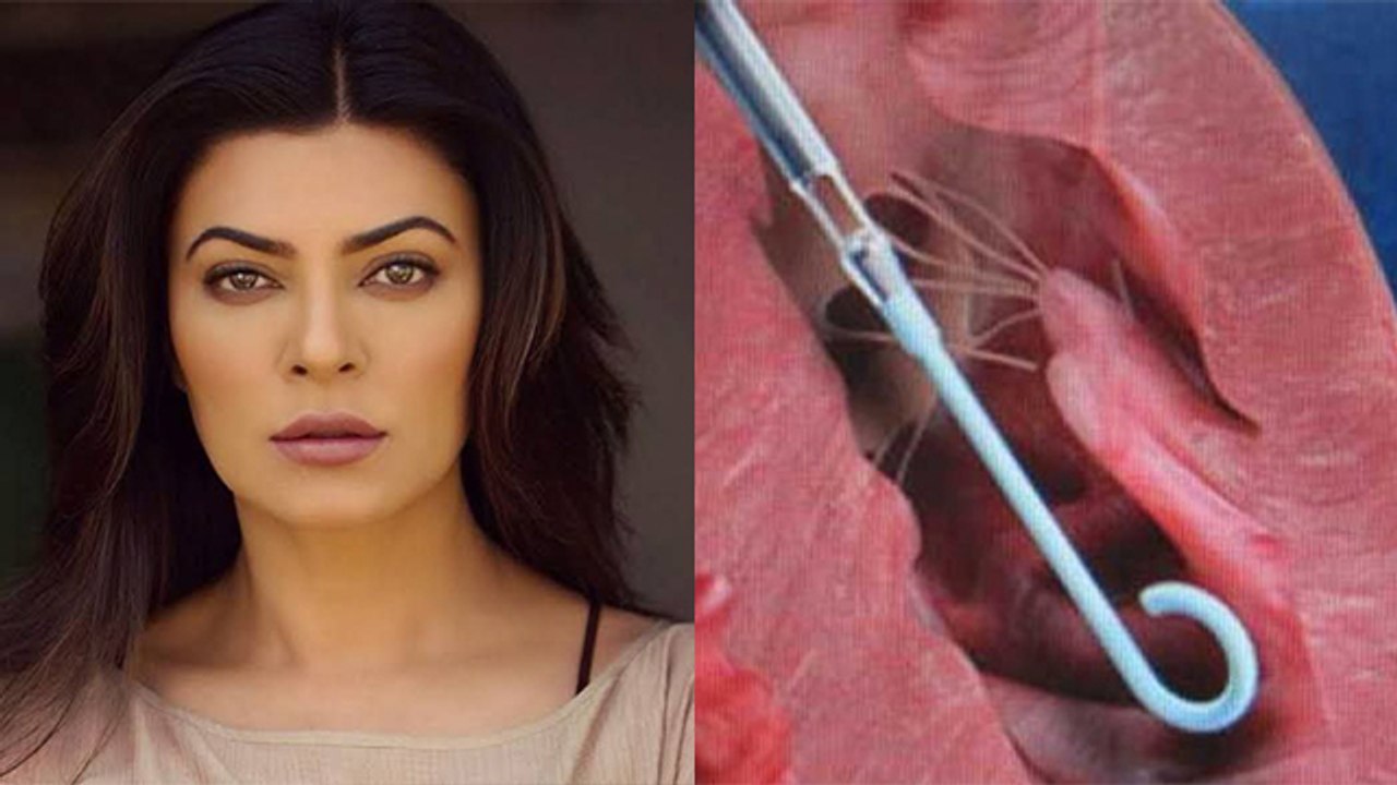 Heart Attack में कब करते हैं Angioplasty, Stunt न डालने पर क्या होता है ...