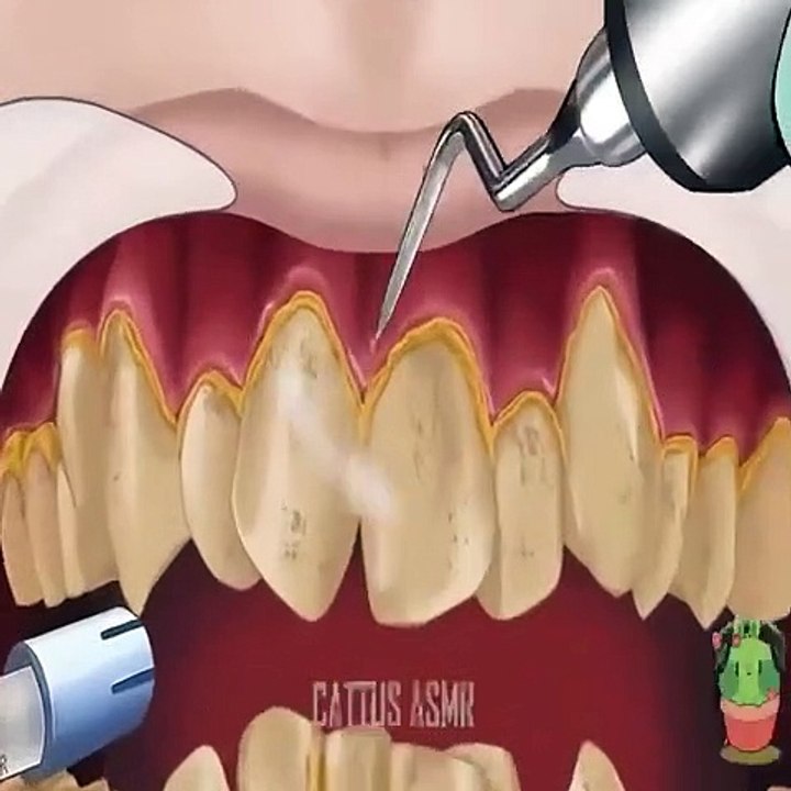 Awesome ASMR! Caries Removal and Tooth Decay Animation _ ASMR ANIMATION ...