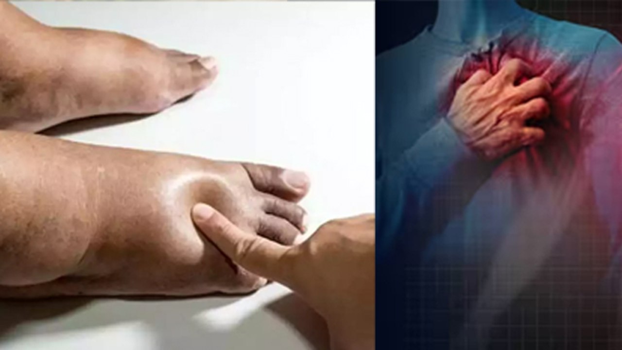 Leg Swelling Heart Attack Symptom कैसे | पैर में सूजन हार्ट अटैक का ...