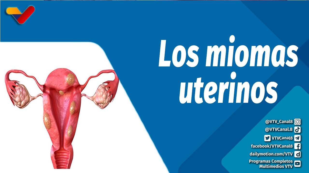 Actitud Saludable | Qué son los miomas uterinos y cómo tratarlos ...