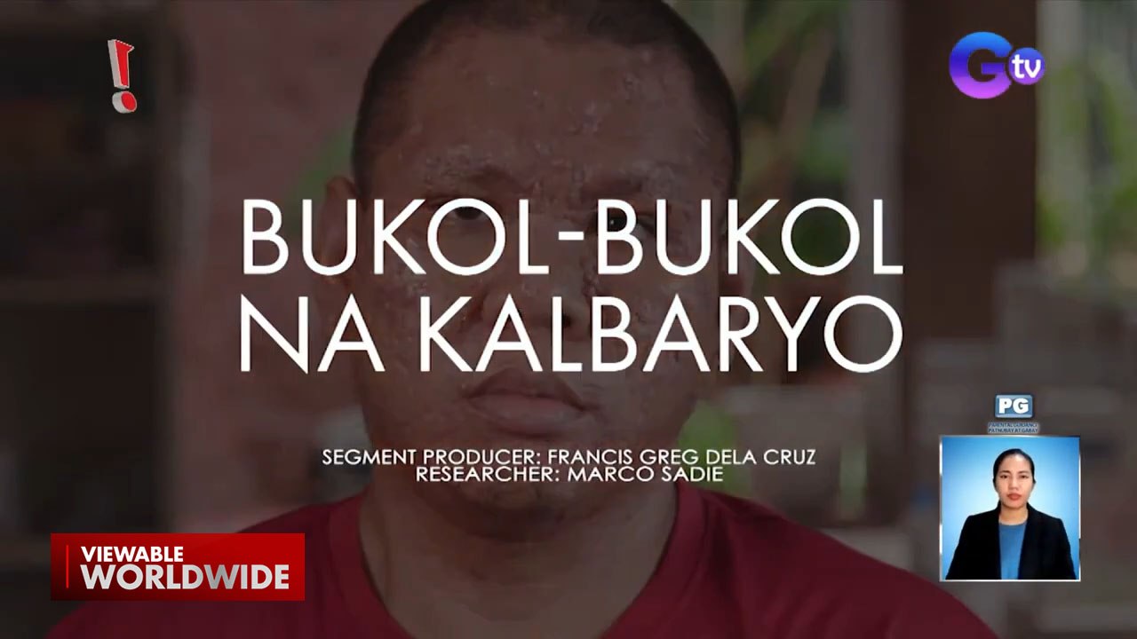 Mga bukol na tila pigsa, tumubo sa mukha, tainga, at kili-kili ng isang ...