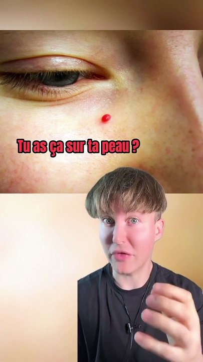 L’angiome rubis, c’est quoi ? - Vidéo Dailymotion