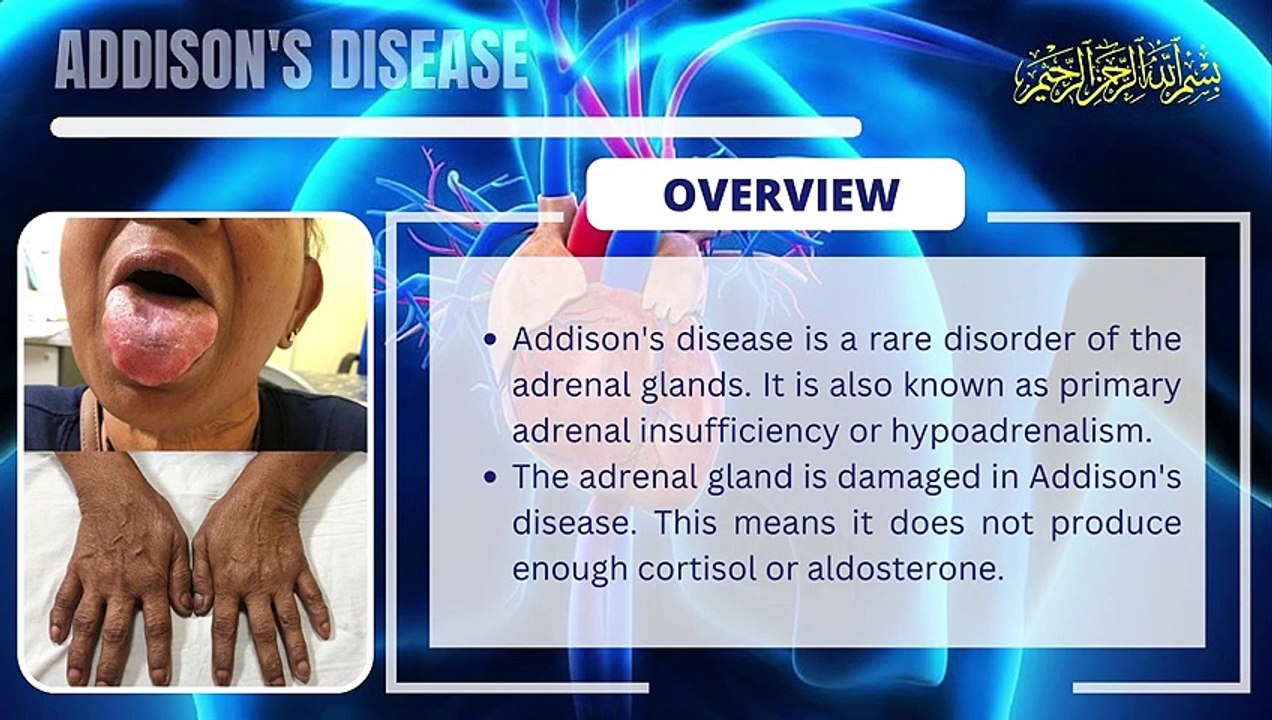 Addison's disease - video Dailymotion