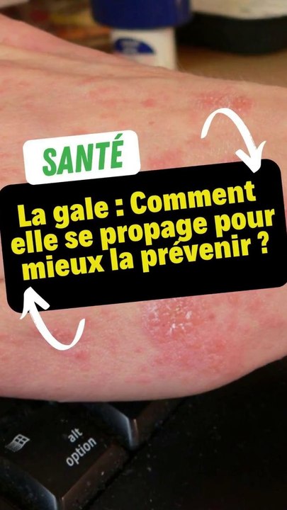 La gale : Comment elle se propage pour mieux la prévenir ? - Vidéo Dailymotion