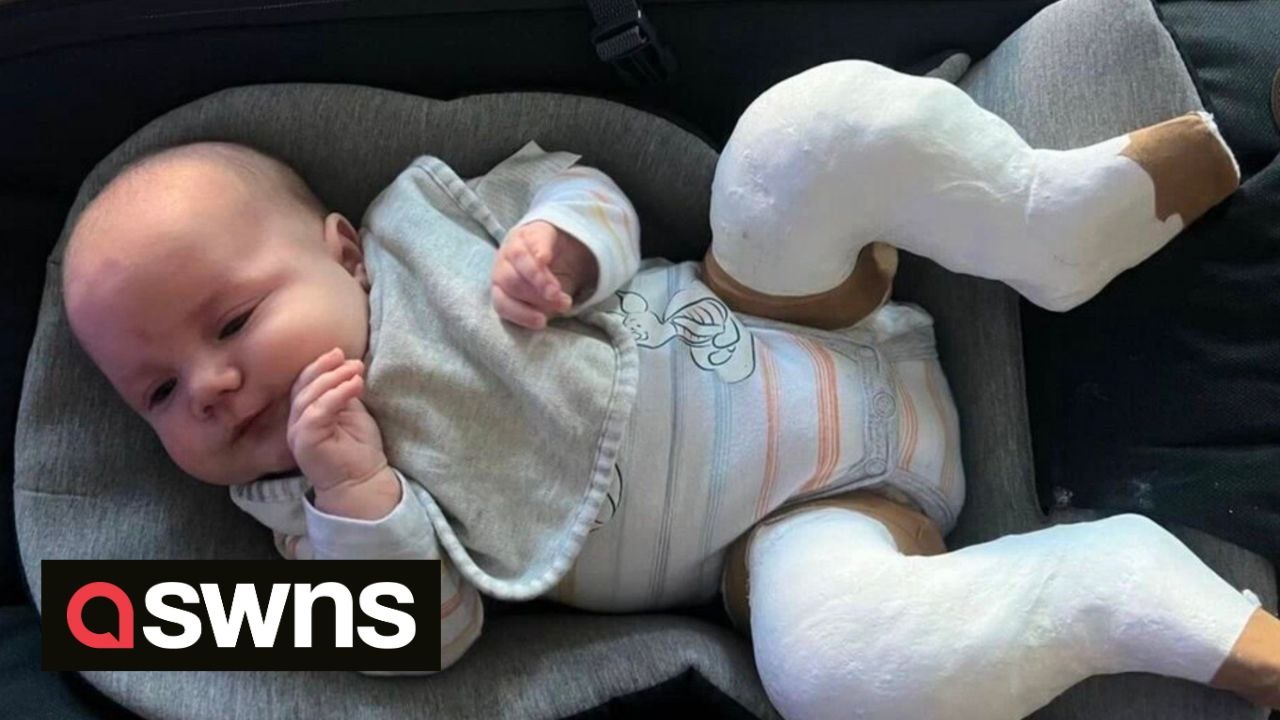Baby has spent half of his life in leg casts after he was born with his ...